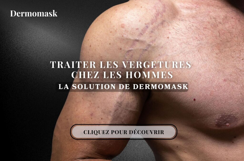 Vergetures chez les hommes : causes, prévention et traitements haute ...